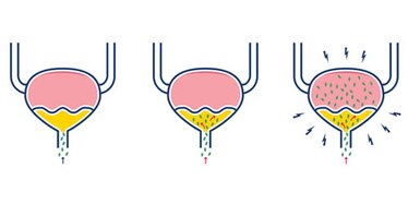 Incontinence Pads & Products | Advice | TENA South Africa